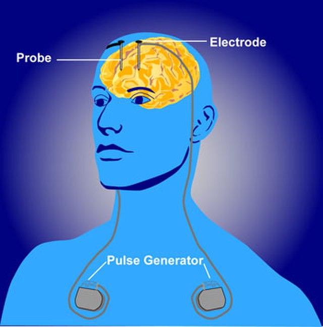 Shocking news? Why scientists stimulate the brain and the importance of ...